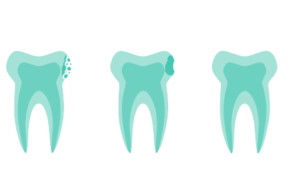 Interproximal – Icon® by DMG